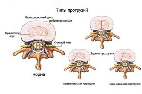 Лечение Протрузии дисков Позвоночника в Киеве поясничного шейного и грудного отдела