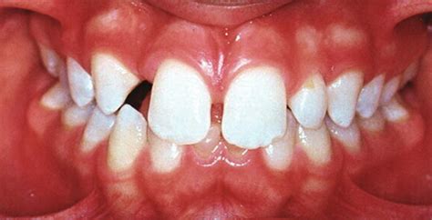 Congenitally Missing Teeth