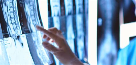 Ai Assistance Improved X Ray Fracture Detection With No 45 Off