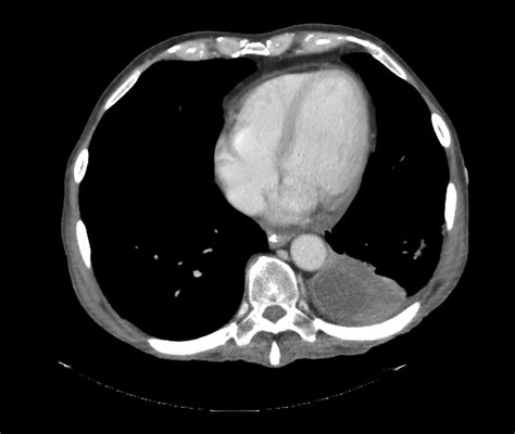 Cross‐sectional Ct With The Lung Mass Download Scientific Diagram