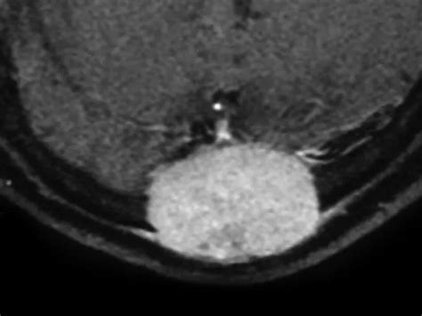 Myeloid Sarcoma Radiology