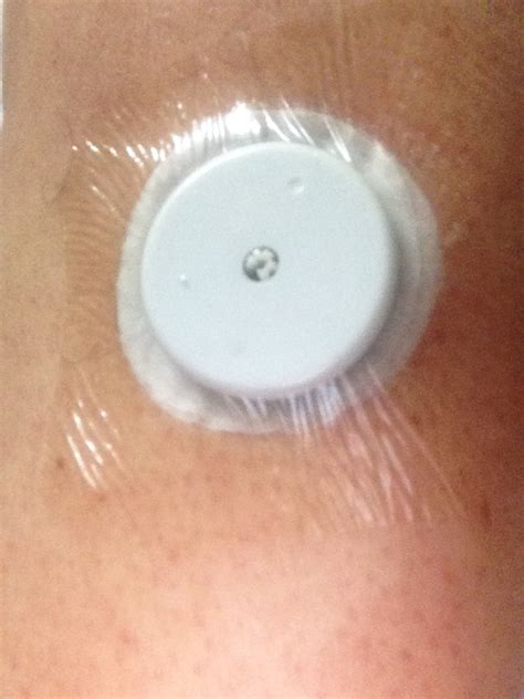 Freestyle Libre Poll Have You Had A Skin Reaction Page 4