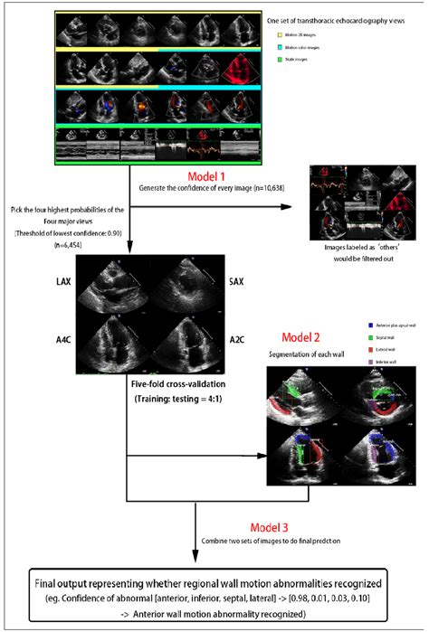 Electrocardiogram Based Prediction Of Myocardial Infarction And An Automated Echocardiographic