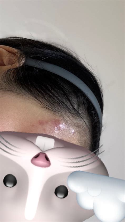 여드름 염증 지식in