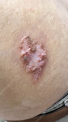 Pyoderma Gangrenosum Stock Image C Science Photo Library