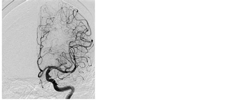 Successful Reperfusion With TICI 3 Recanalization Download Scientific Diagram