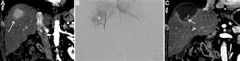 Advances In Y 90 Radioembolization For The Treatment Of Hepatocellular Carcinoma