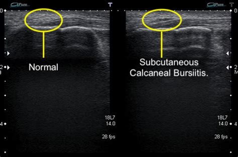Subcutaneous Calcaneal Bursitis Ankle Foot And Orthotic Centre