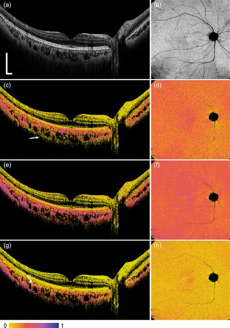 Images Of The Human Retina In Vivo A B Scan Of OCT Intensity A En Download Scientific