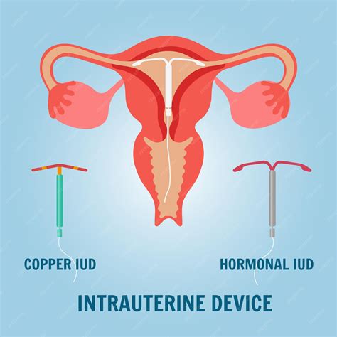 Premium Vector Medical Picture Of Intrauterine Devises In Female Reproductive System In Vector