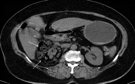 Emphysematous Pyelonephritis