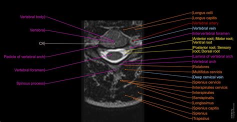 Cervical Spine Mri Normal Anatomy E Anatomy