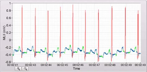 Ecg Multi Resolution Analysis And Implementation Of Qrs Detection