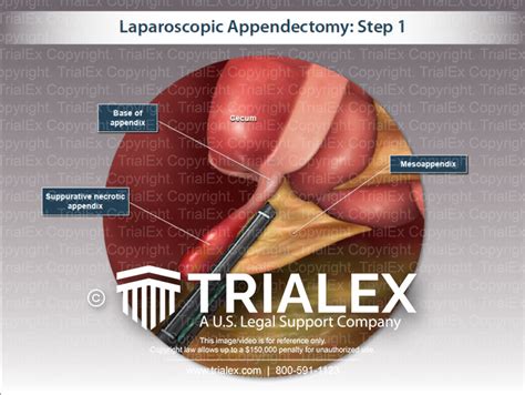 Appendectomy With Endoloop At Randy Arndt Blog
