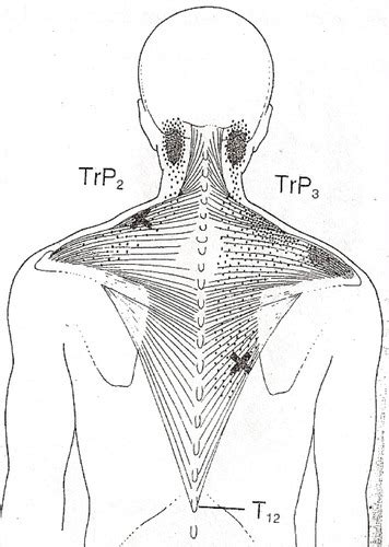 Trigger Points Pictures Flashcards Quizlet