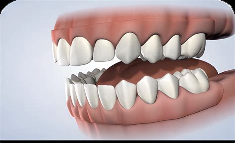 Pre Prosthetic Surgery In Amarillo Tx