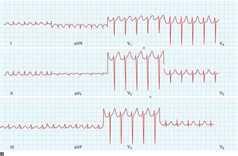 Khmer Medecine Atrial Flutter
