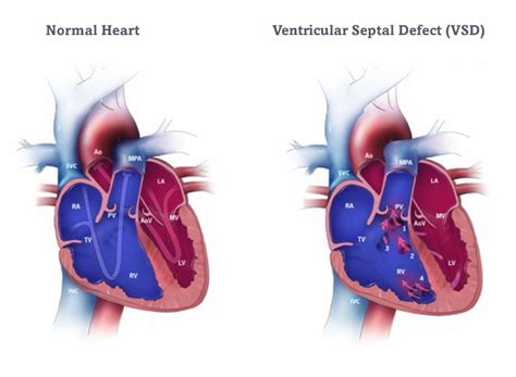 Ventricular Septal Defect Acha