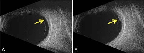 Dynamic Echography Of Varix Of The Vortex Vein Ampulla Retinal Cases