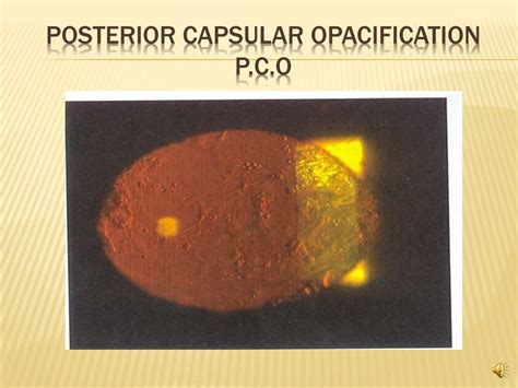 Ppt Posterior Capsular Opacification P C O Powerpoint Presentation