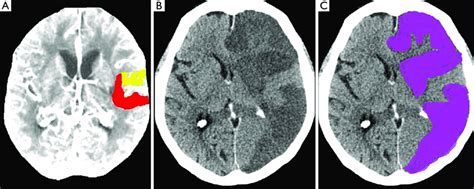 Underestimation Of Infarct Core Volume On Ct Perfusion Map Ct
