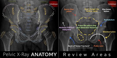 Normal Hip Joint Anatomy Xray Westsilicon