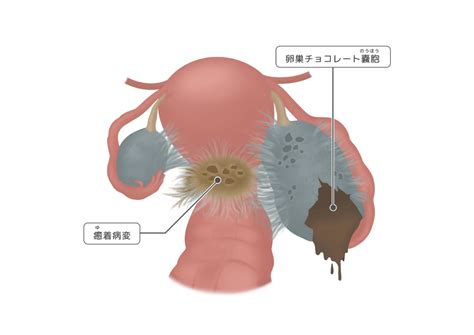子宮内膜症 ｜世田谷区経堂の婦人科｜波平レディスクリニック｜子宮頸がん予防と治療、不育症・不妊症、男女の産み分け