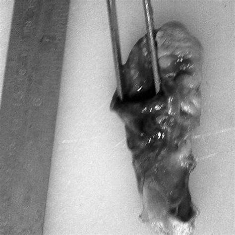 Gallbladder Perforation Due To Drug Intoxication Download Scientific Diagram