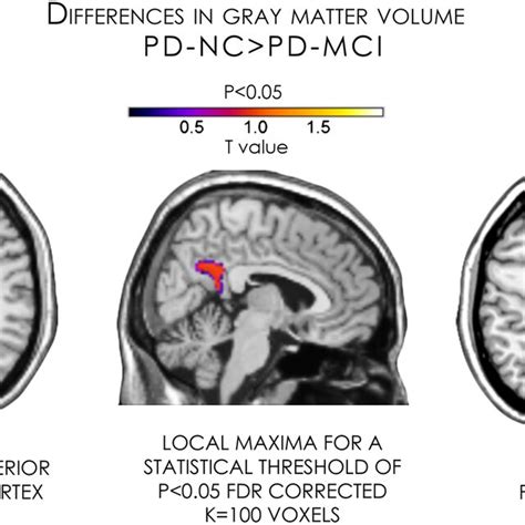 Voxel‐based Morphometry Showing Decreases In Gray Matter Volume In Download Scientific Diagram
