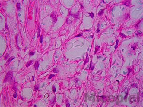 Caso Clínico Nº 24 Criptococosis Cutánea Con Diseminación Al Snc En