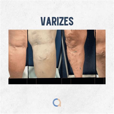 Como Saber Se Tenho Varizes Dra Catarina Almeida