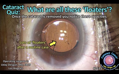 Cataract Quiz What Are These Floaters After Cataract Surgery