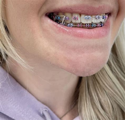 Braces Ideas Apparecchio Per I Denti Idee Di Moda Denti