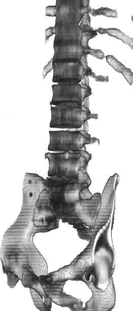 3d Renderings Of Bones From Ct Slice Interpolation Results Bicubical Download Scientific