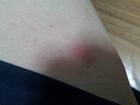 모기진드기 뭐에 물린 자국이죠 네이트 판