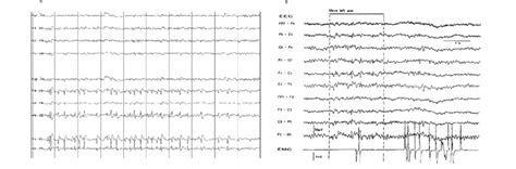A Eeg On Day 0 Following Cardiac Arrest Demonstrates Narrow Polyspikes