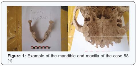 Open Access Journal Of Surgery Oajs Juniper Publishers