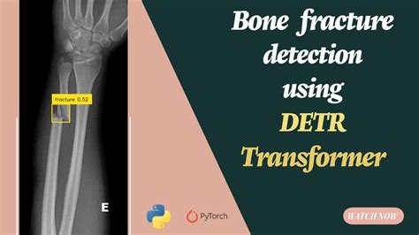 Object Detection Using Detection Transformer Detr For Bone Fraction