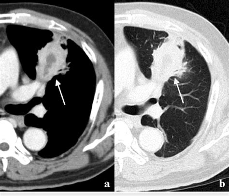 Enhanced Chest Ct The Enhanced Chest Ct Showed A 40 Cm Mass Like