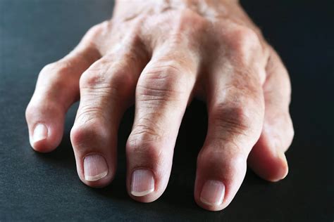 Doctors Strive For Quicker Diagnosis Of Rheumatoid Arthritis