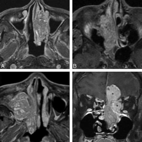 Pdf Sinonasal Inverted Papilloma Value Of Convoluted Cerebriform