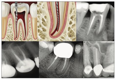 Instrumentation Errors Tips And Tricks To Avoid It Dentistry Today