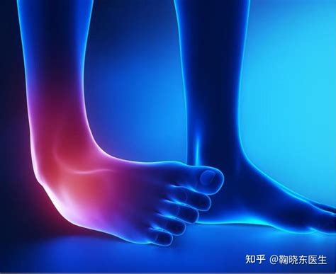 多次崴脚关节废了医生提醒脚踝韧带撕裂会引起创伤性关节炎 知乎