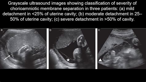 Uogjournal Video Clip On Chorioamniotic Membrane Separation Following Fetal Myelomeningocele