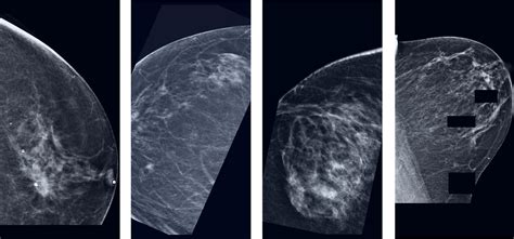 Github Bishnarender Rsna Screening Mammography Breast Cancer Detection Identify Breast Cancer