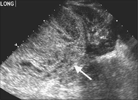 Neuroblastoma Ultrasound