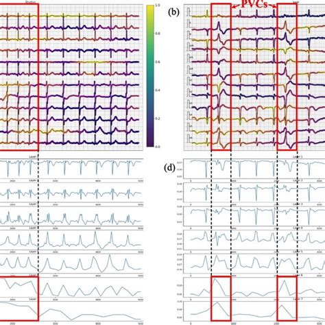 Visual Interpretation Of The Model A B The Ecgs Of Af And Pvcs Which Download Scientific