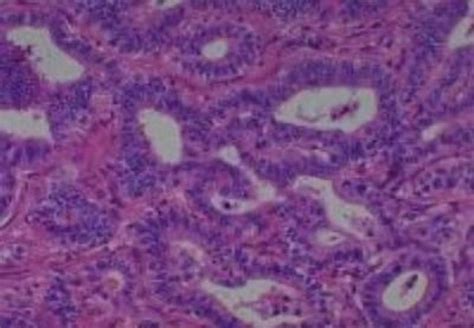 Novus Biologicals Human Multi Tissue Tissue Microarray Cancer Human