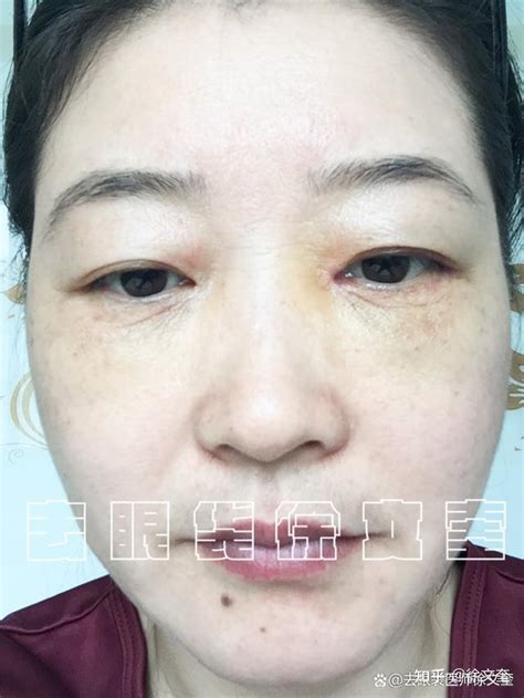 中老年人眼袋手术要点47岁还能做超微创去眼袋吗 知乎