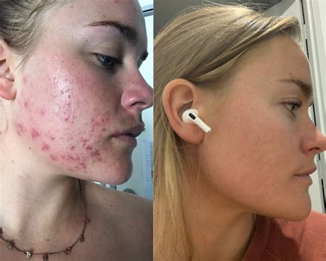 Best Tips For Hormonal Acne Clear Skin Secrets Unveiled Best Blackheadremoval Guide For Your